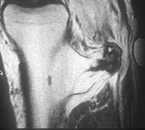 Osteochondroma & Multiple Hereditary Exostosis - Pathology - Orthobullets